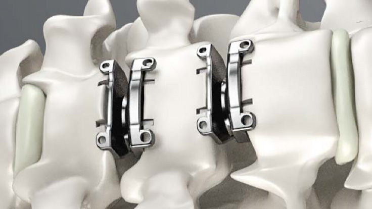 Medtronic’s FDA approval for two-level Prestige LP procedures - Today's ...