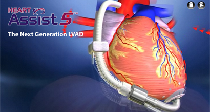 Remote Monitoring of Micromed’s Heart Pump - Today's Medical Developments