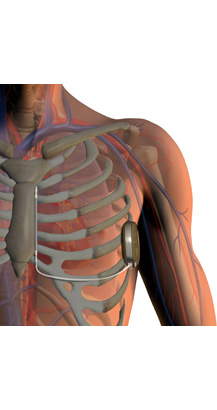 Completely Subcutaneous Implantable Defibrillator - Today's Medical ...