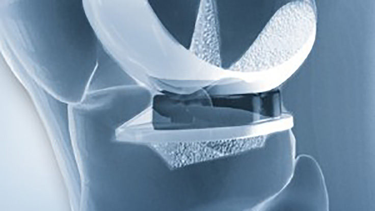 Invibio, Maxx Orthopedics collaborate on knee-replacement technology ...