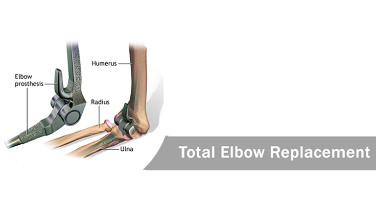 Standard to test, improve elbow prostheses - Today's Medical Developments