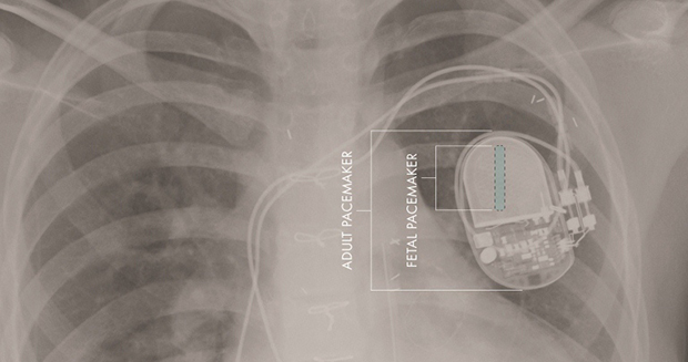 Micropacemaker designed for fetal use - Today's Medical Developments