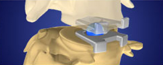 FDA Clearance of Spinal Implant - Today's Medical Developments