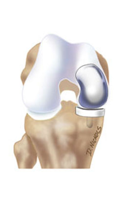 CADD Edge to Spotlight ConforMIS’ Revolutionary Medical Designs - Today ...
