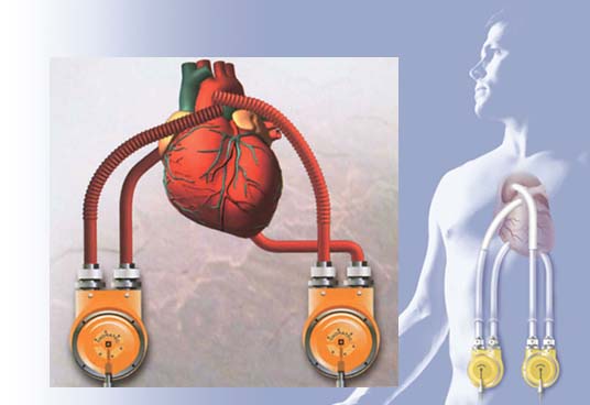 Thoratec Acquires Catheter-Based Heart Pump Technology - Today's ...