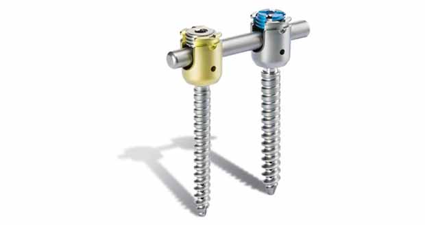 New spinal implant for U.S. market - Today's Medical Developments