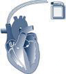 MARKET FOR HEART DEVICES MAY GET A BOOST - Today's Medical Developments
