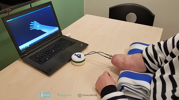 Dexterous, sentient hand prosthesis implanted - Today's Medical ...