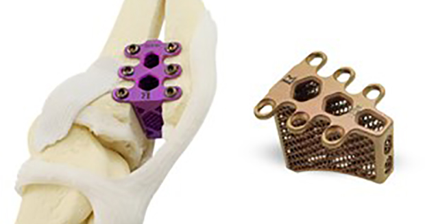 3D printed knee implants - Today's Medical Developments